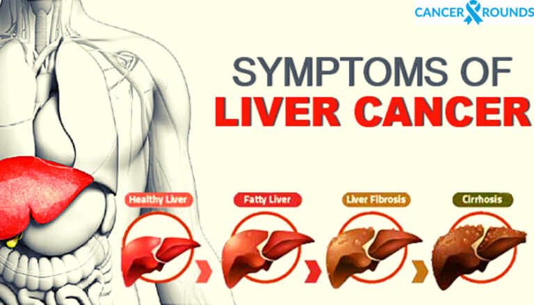 Common Sign & Symptoms of Liver Cancer - Cancer Rounds
